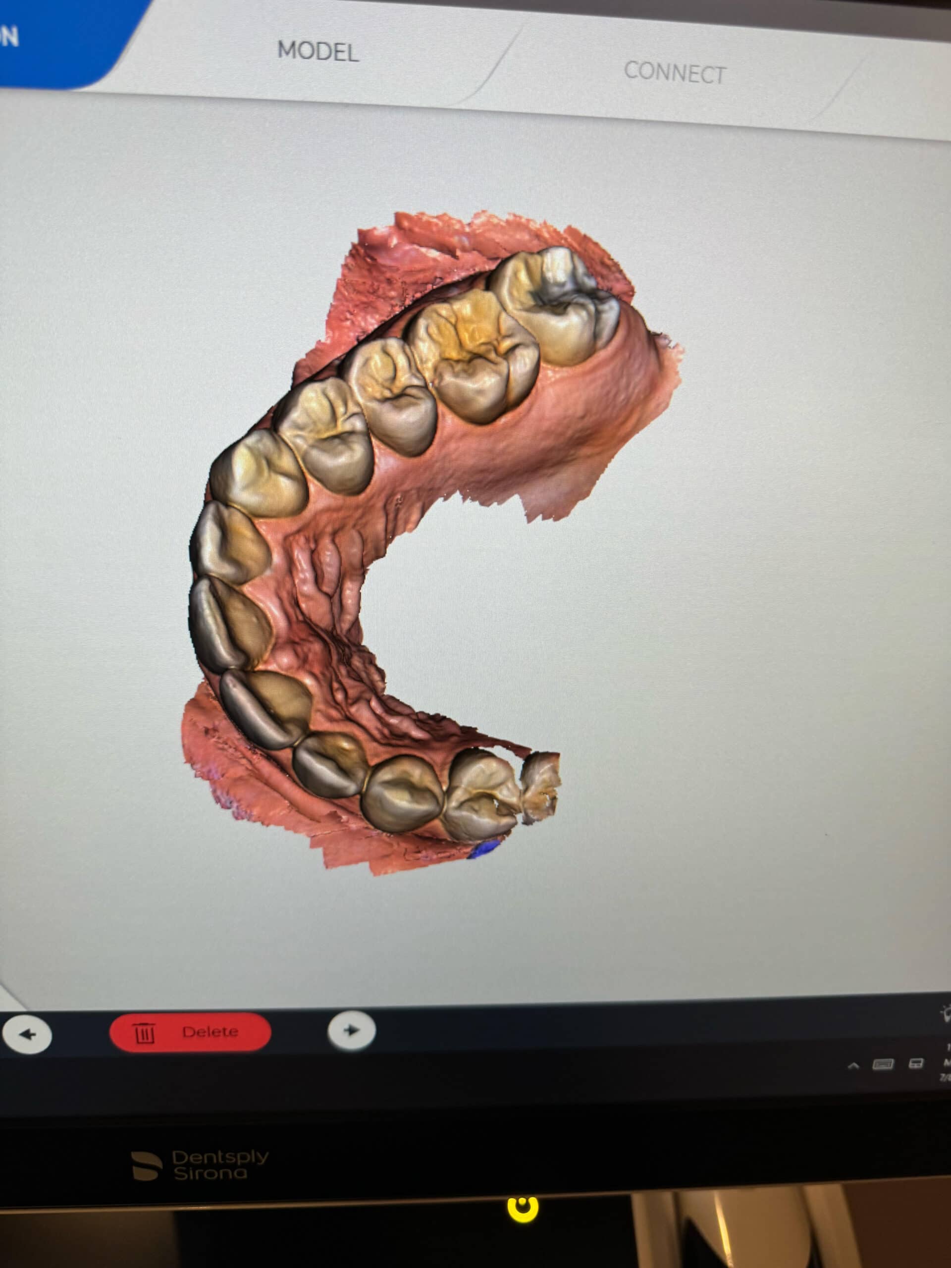 Understanding the Sirona Scanner - Salman Dental